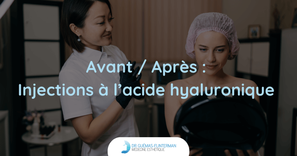 Avant / Après : Injections à l’acide hyaluronique - Dr. Guémas-Flinterman