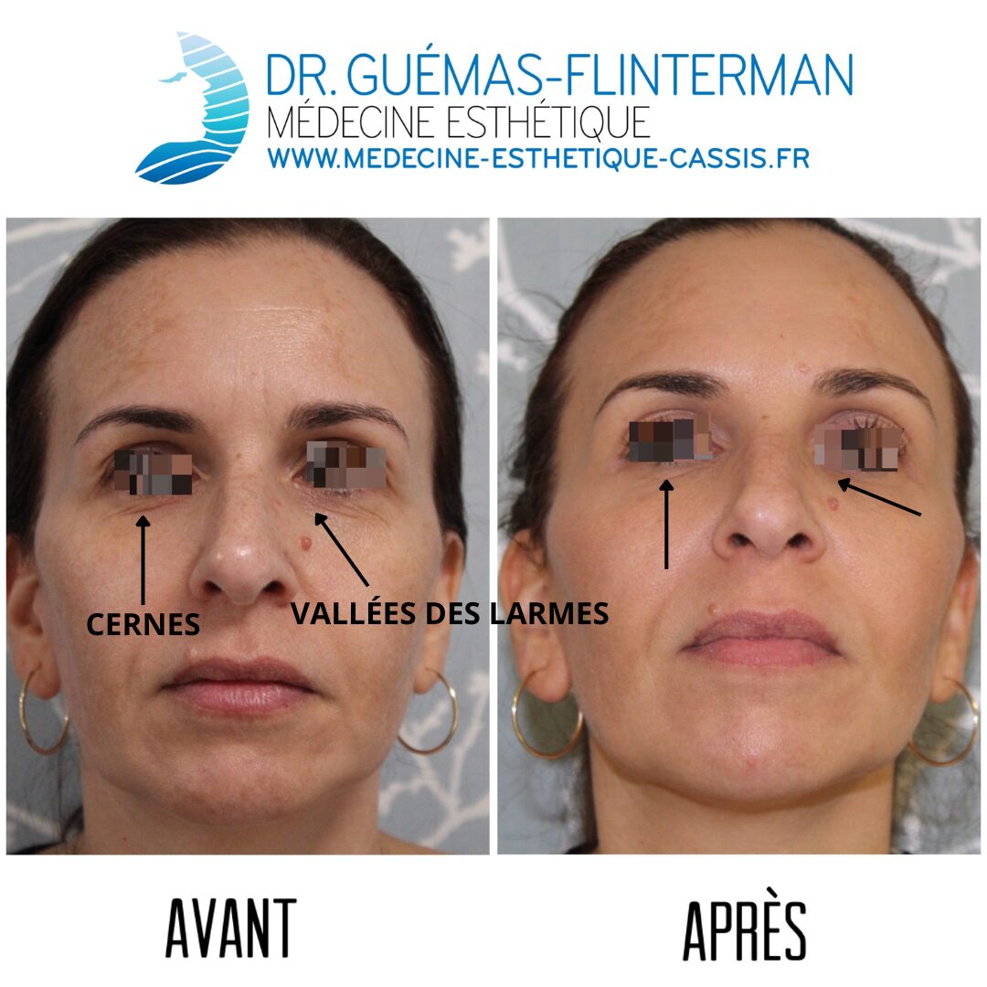 Avant / Après : Injections à l’acide hyaluronique - Dr. Guémas-Flinterman