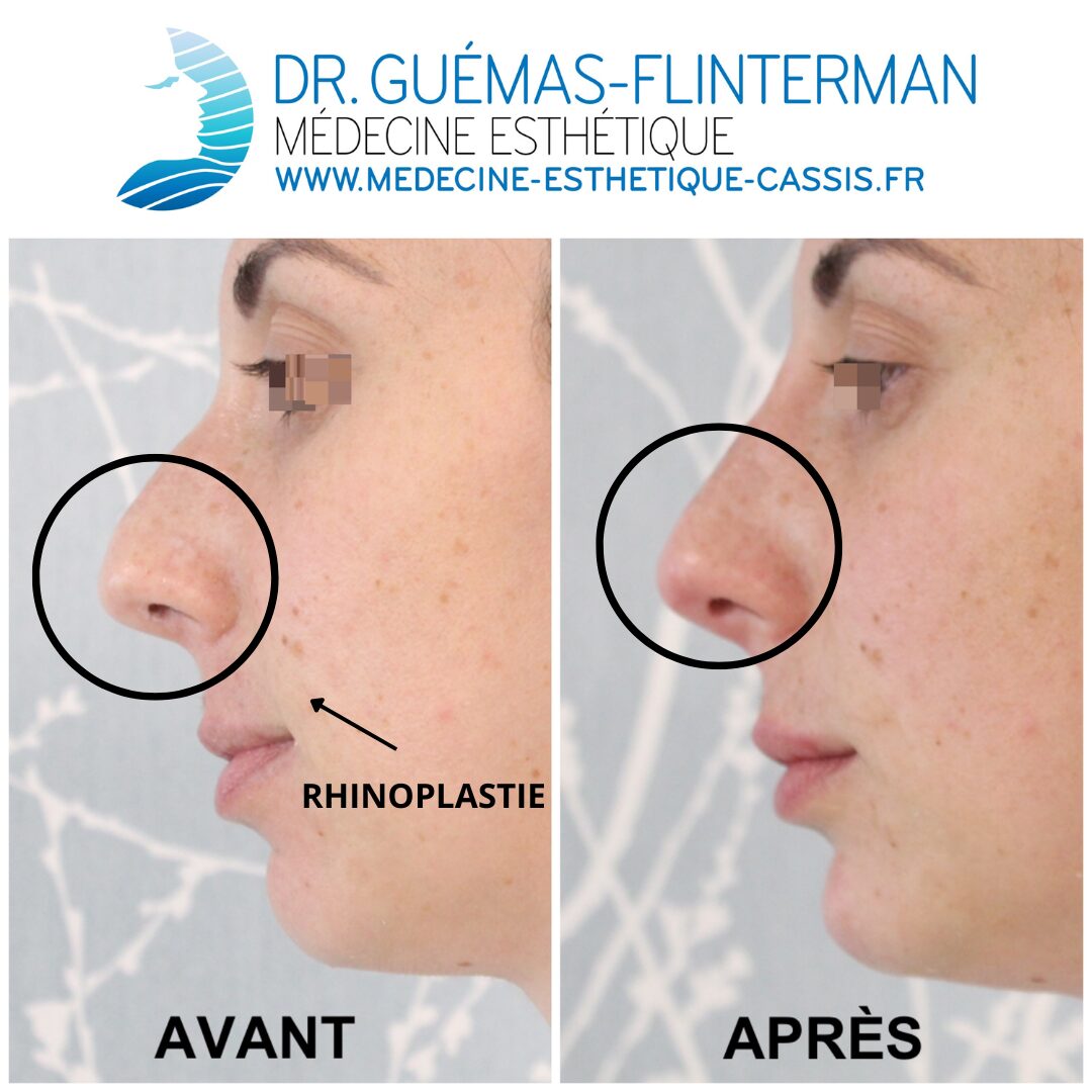 Avant / Après : Injections à l’acide hyaluronique - Dr. Guémas-Flinterman