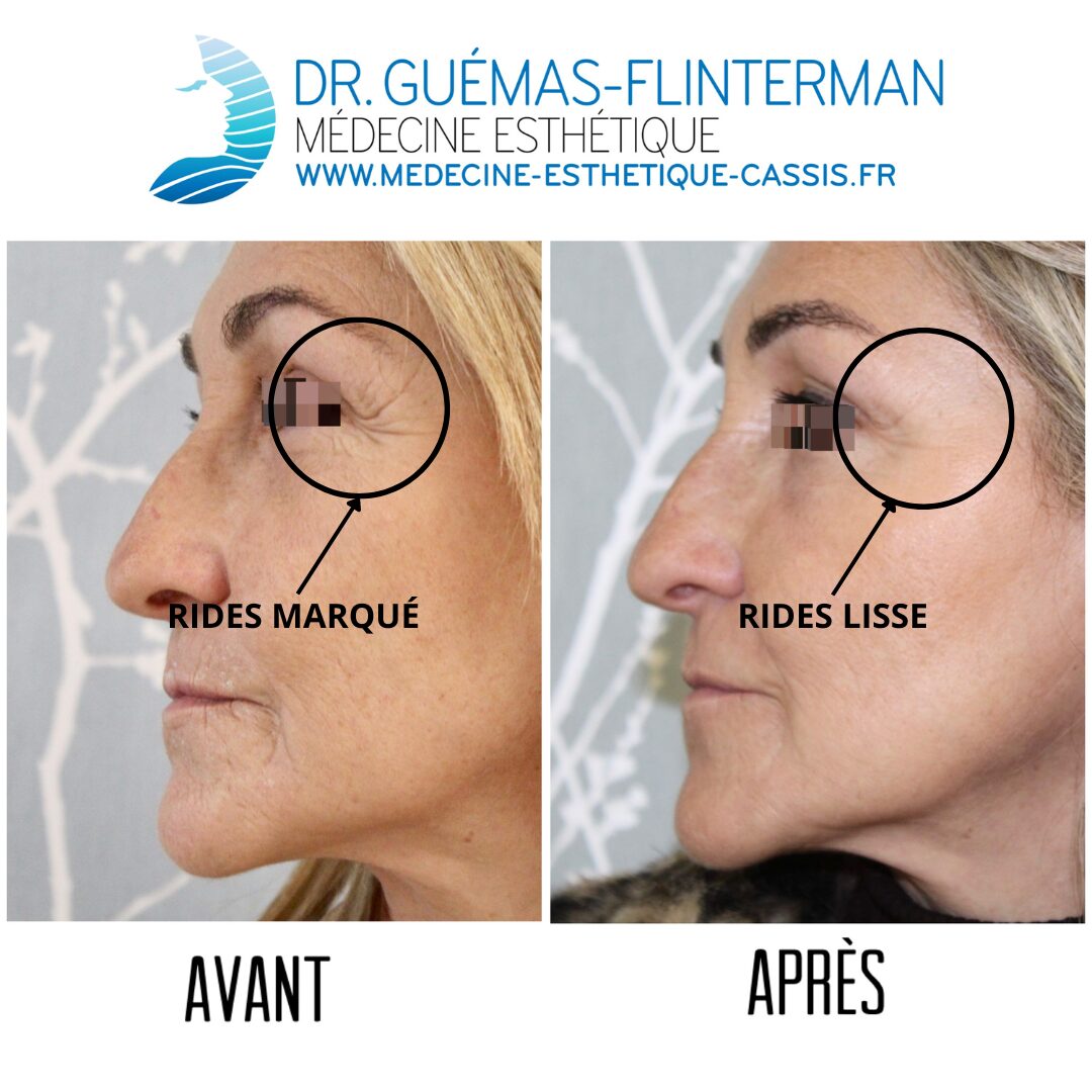 Avant / Après : Injections à l’acide hyaluronique - Dr. Guémas-Flinterman