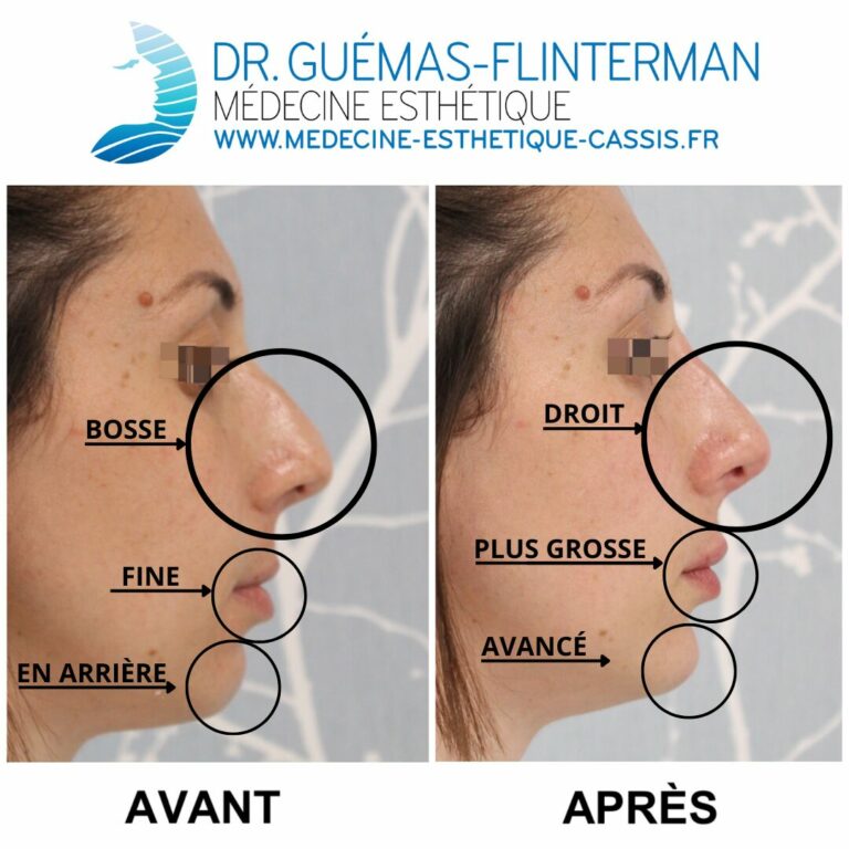 Avant / Après : Injections à l’acide hyaluronique - Dr. Guémas-Flinterman